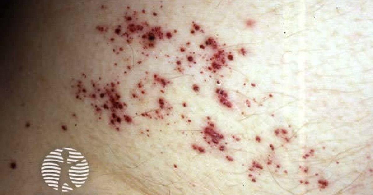 Angioma serpiginosum image