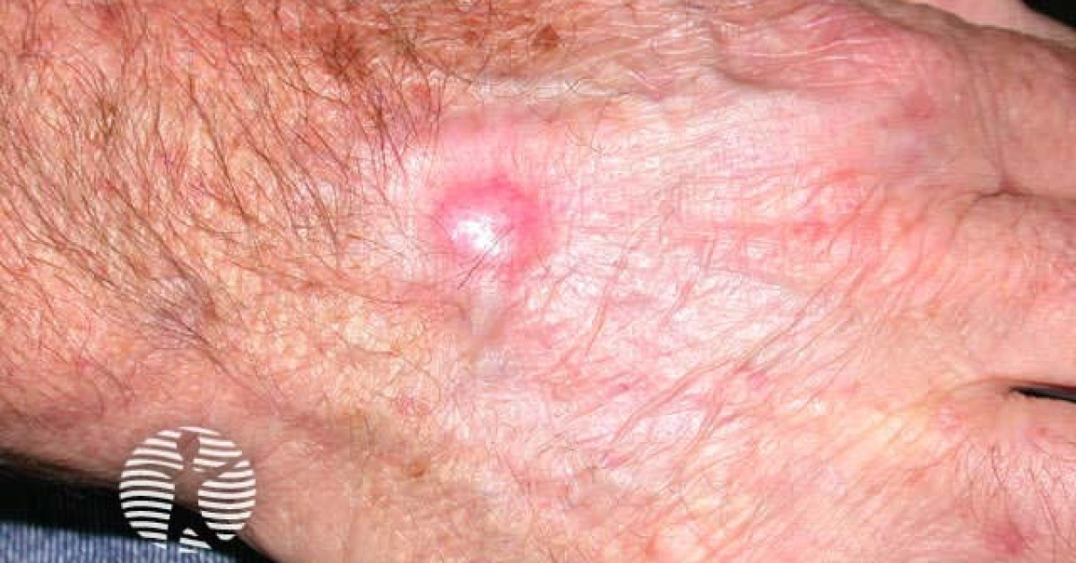 Basal cell carcinoma image