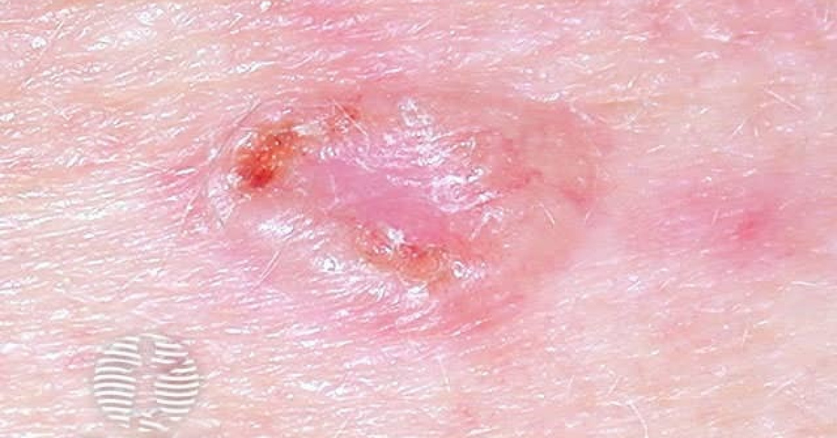 Basal cell carcinoma image