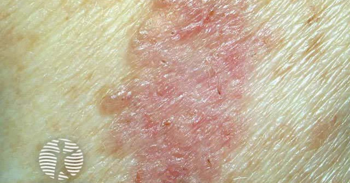 DermNet® - Basal cell carcinoma image