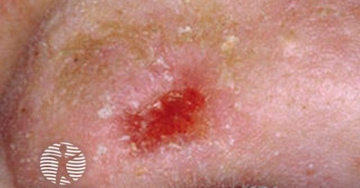 Basal cell carcinoma image