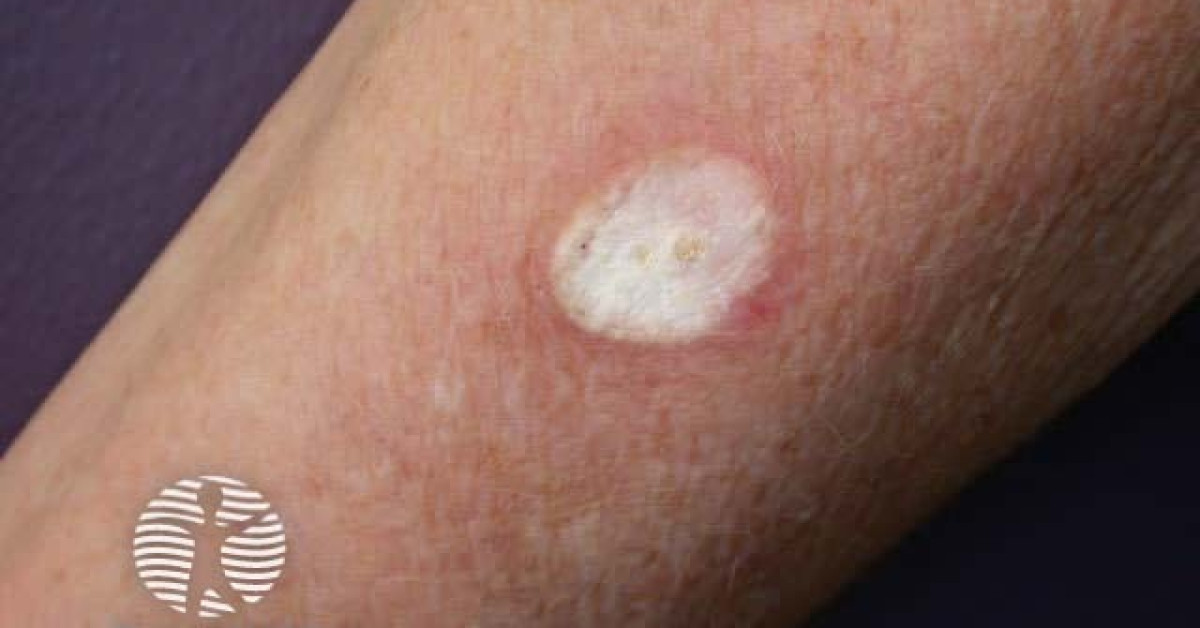 Reaction to cryotherapy image