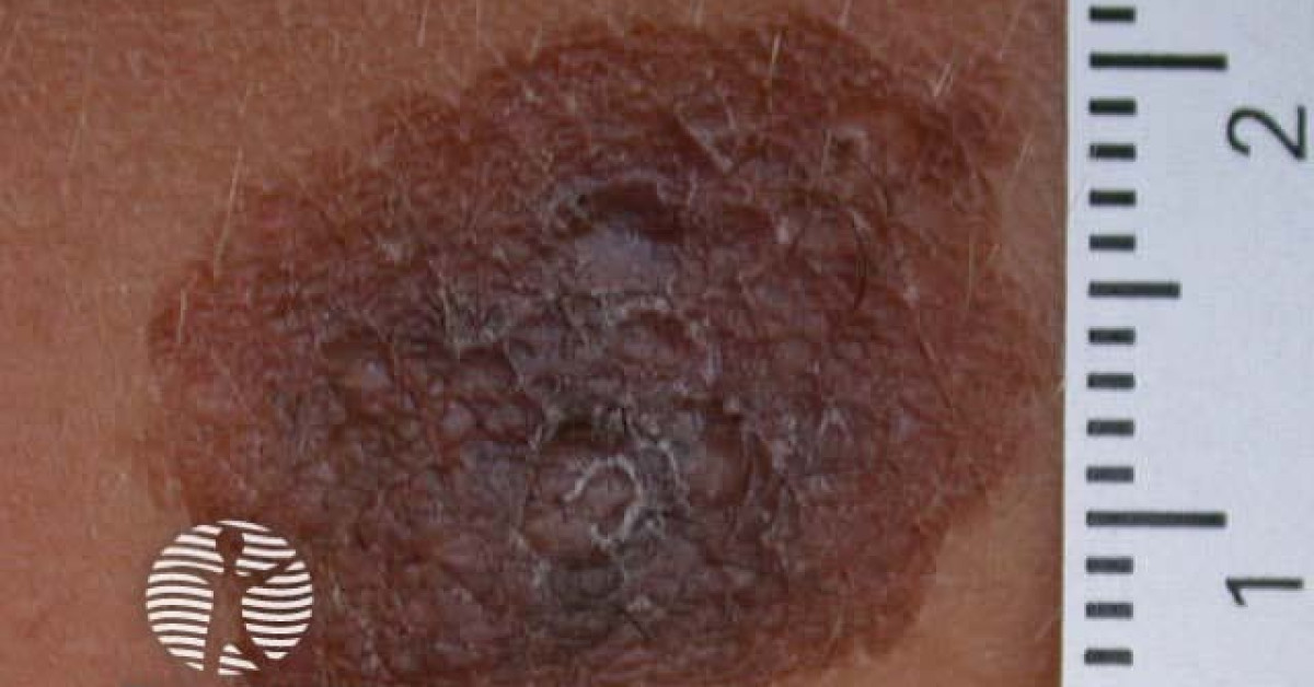 Small congenital naevus image