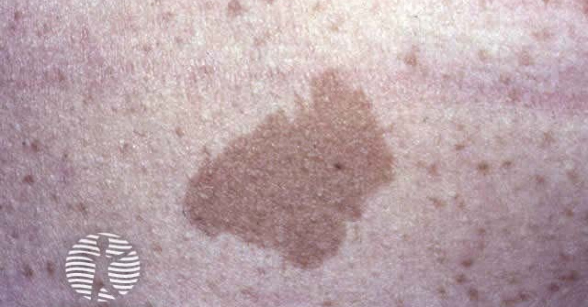 Café au lait macule image