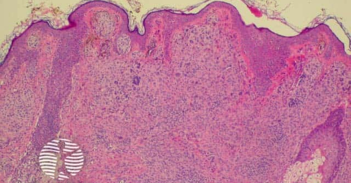 Melanocytic naevus image