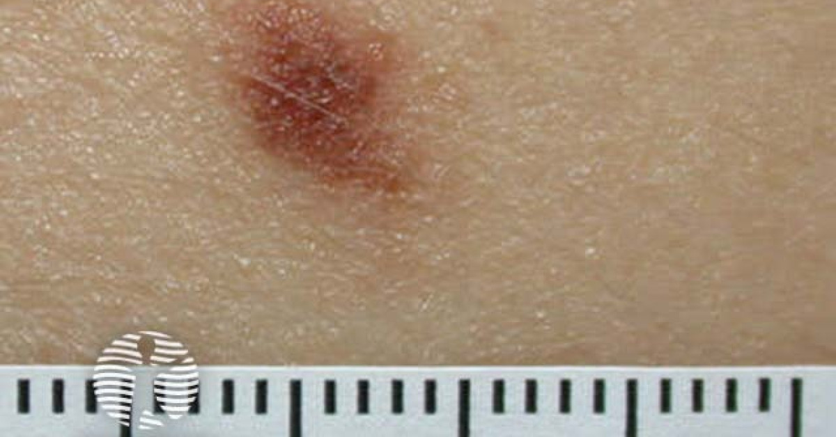 Junctional naevus image