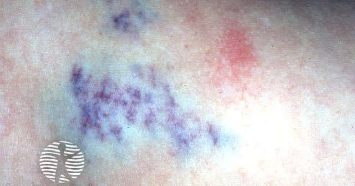 Deep infantile haemangioma image