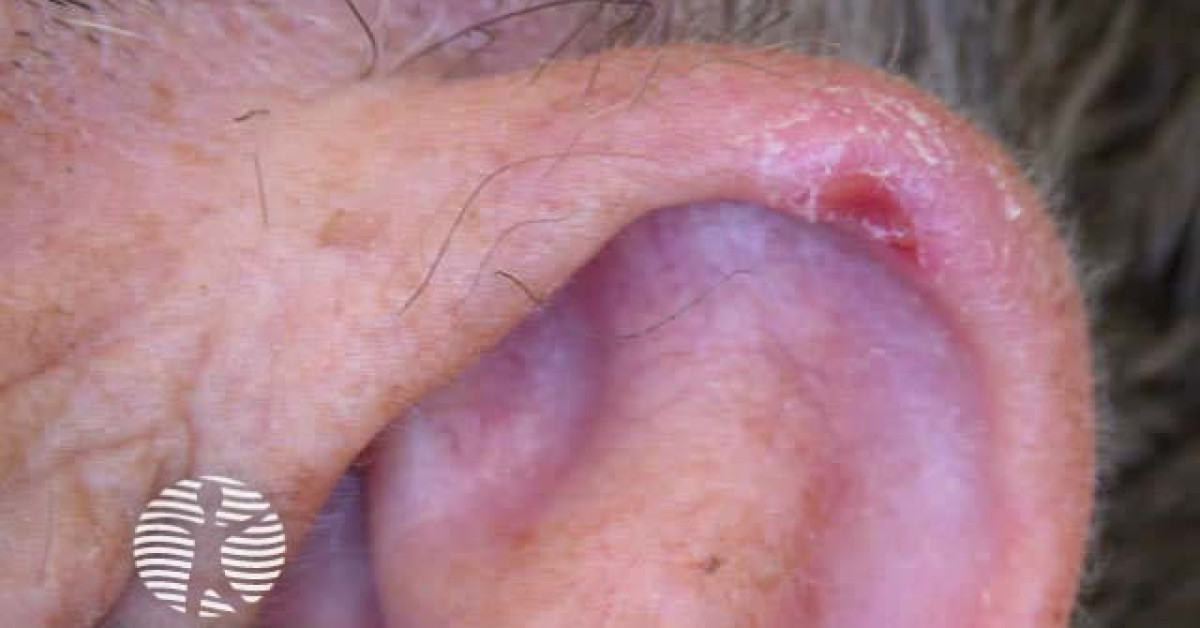 Chondrodermatitis image
