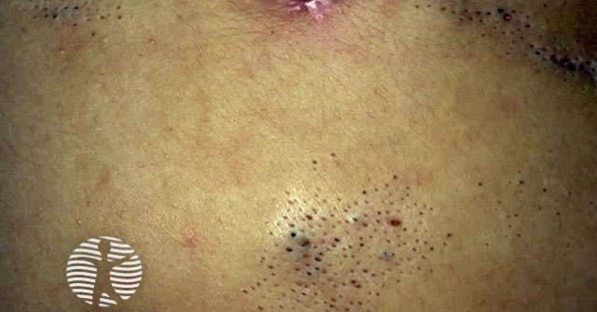 Comedonal naevus image