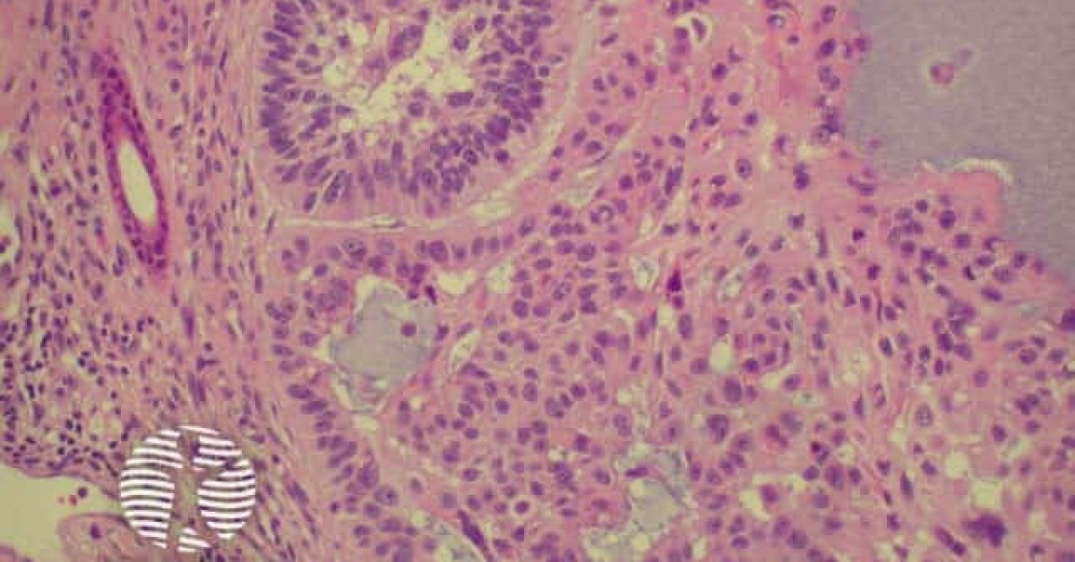 Histology Of Basal Cell Carcinoma Image 2006