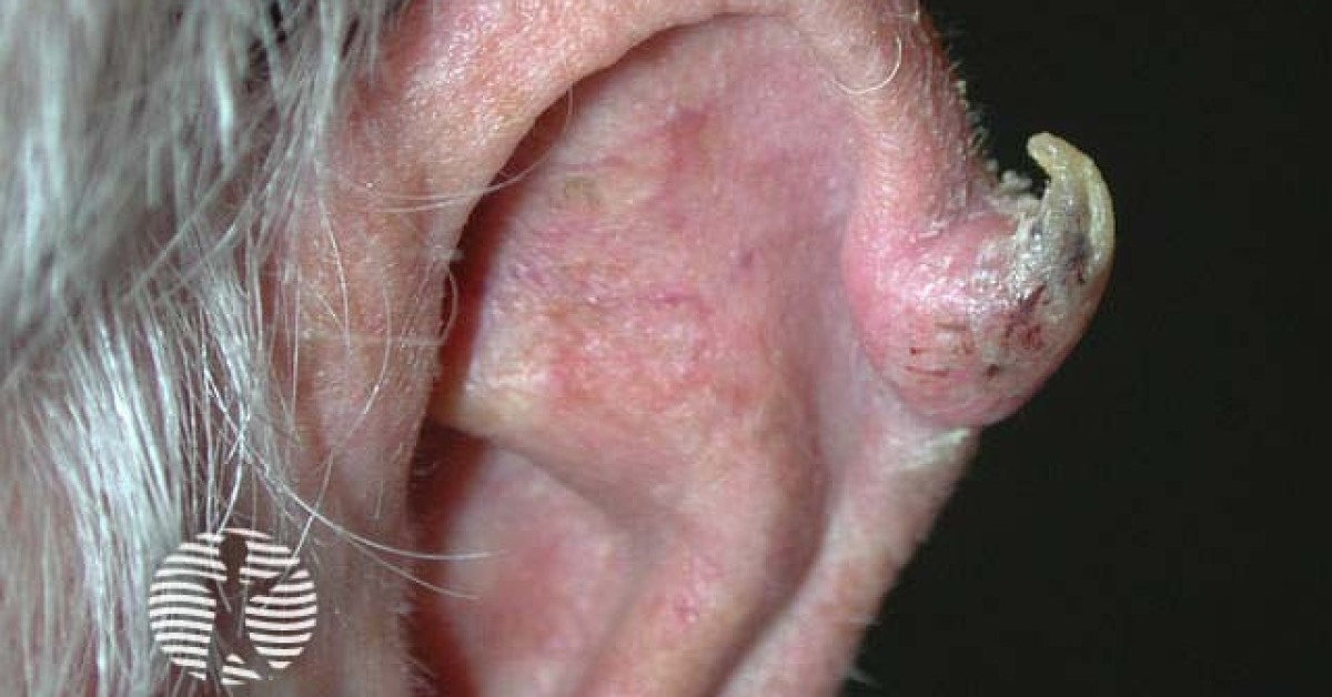Cutaneous horn image