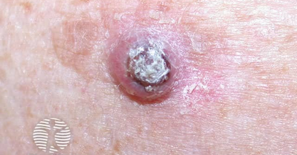 Keratoacanthoma image