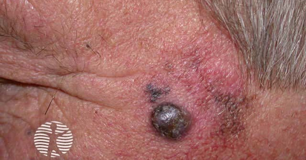 DermNet® - Melanoma image