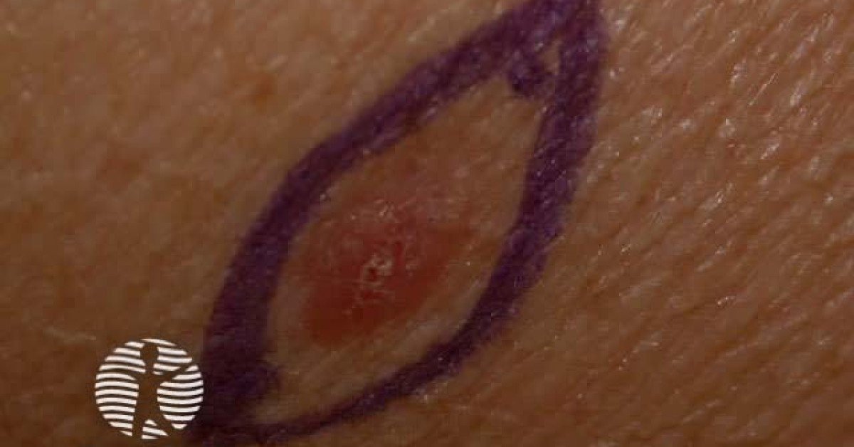 Marking out area to excise image