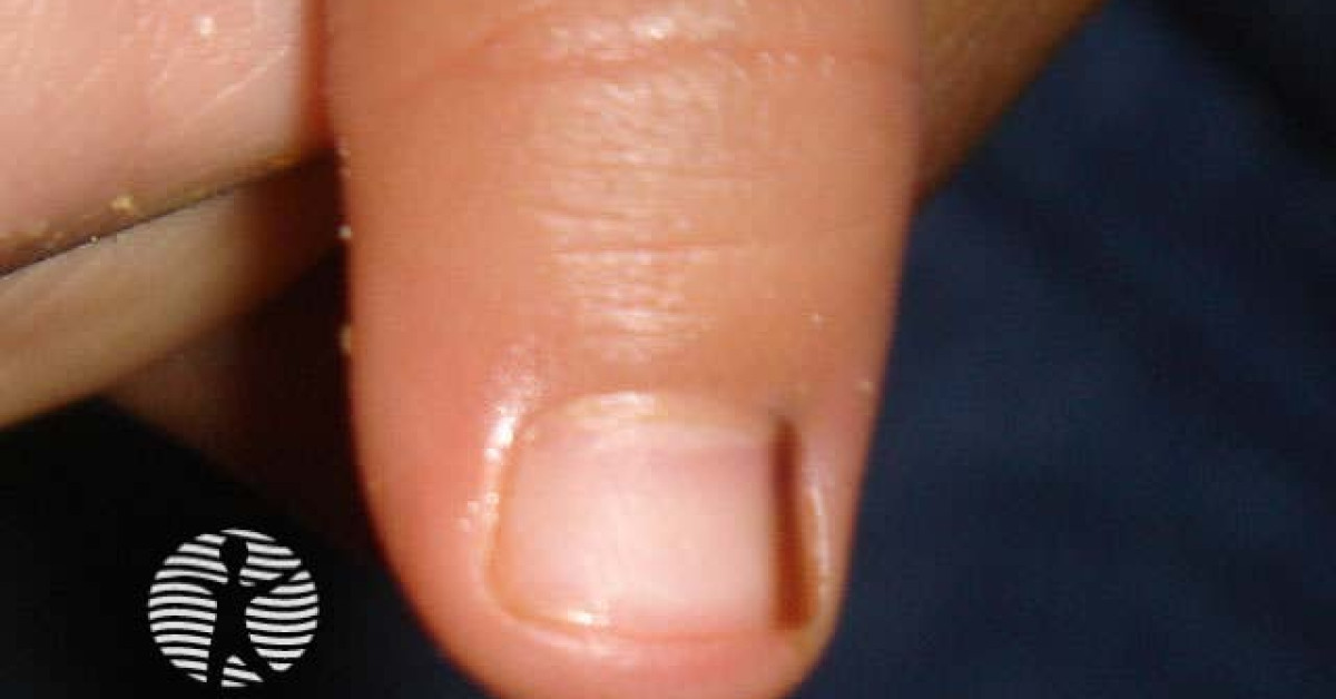 Nail naevus image