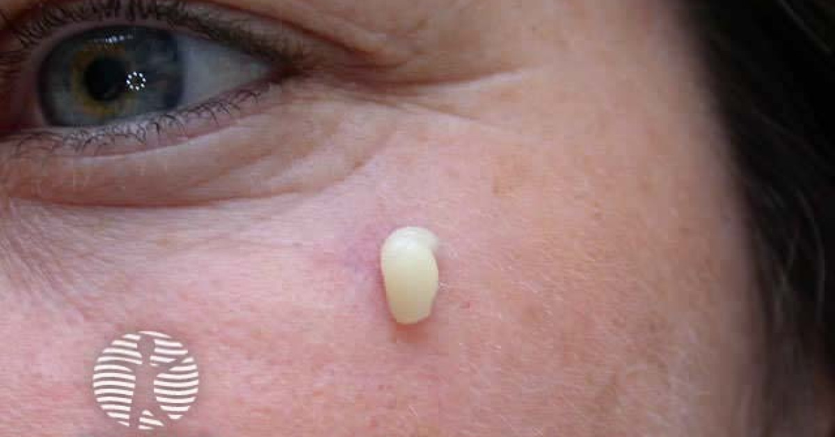 photodynamic therapy: Metvix cream image