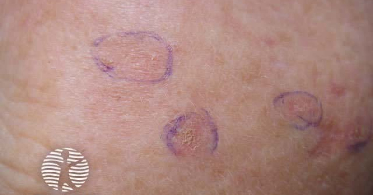 Keratoses marked out for PDT image