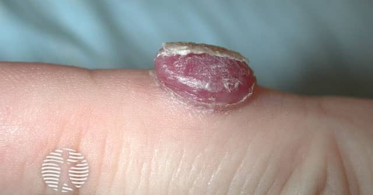 Pyogenic granuloma image