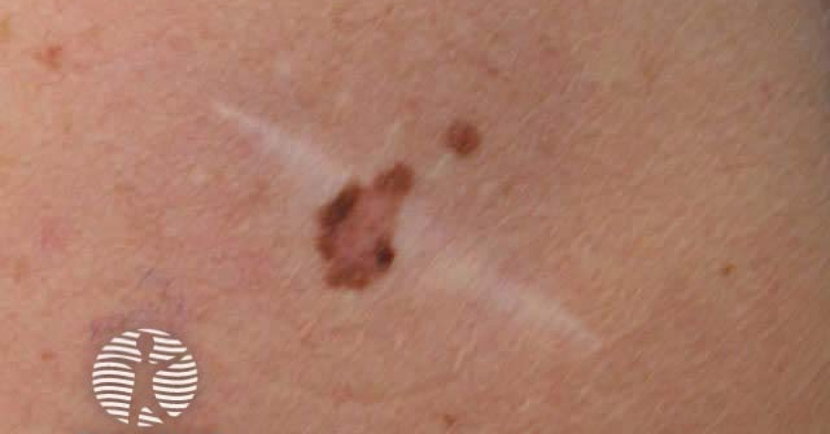 DermNet® - Recurrent naevus image