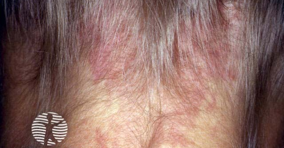 Salmon patch (stork mark) image