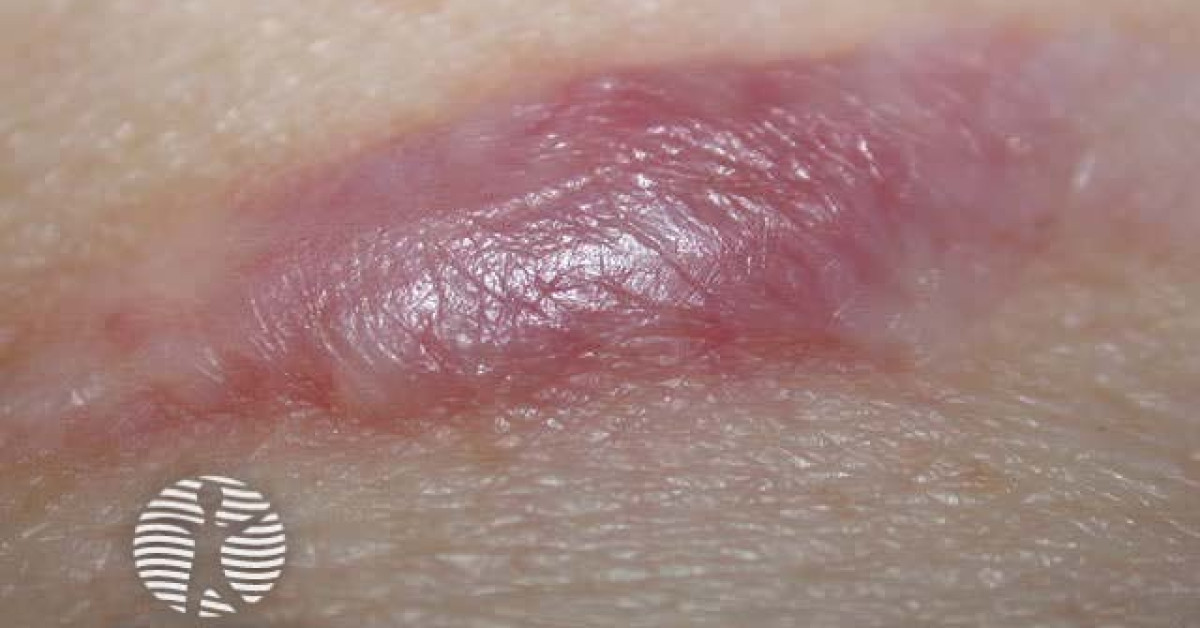 Scar after wound infection image