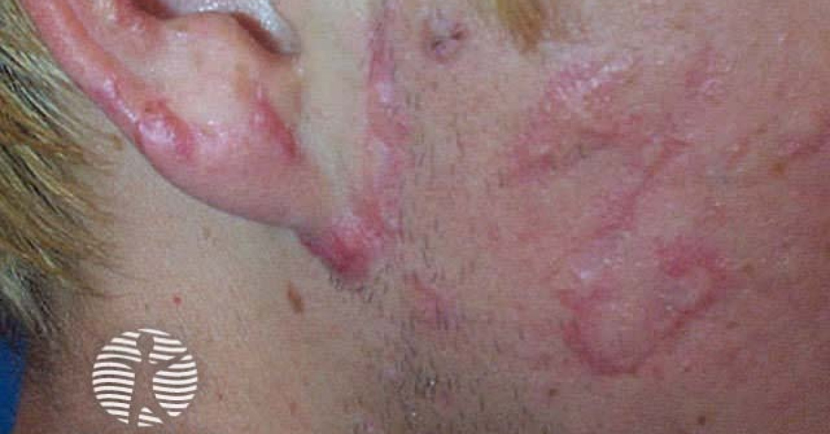 Scars after gravel abrasions image