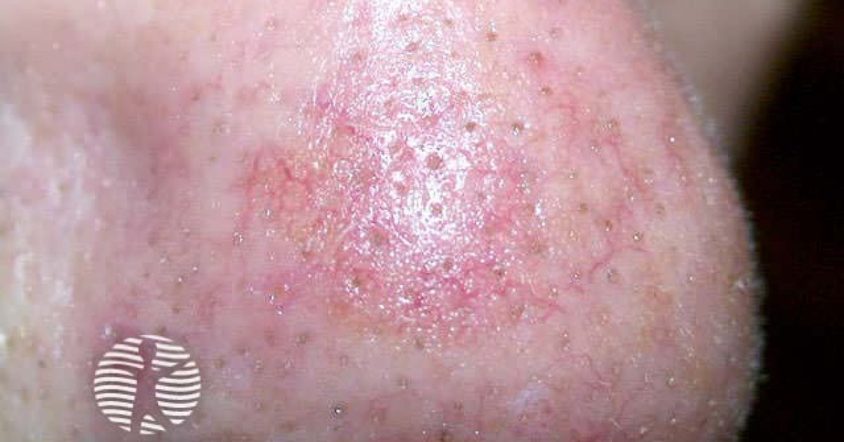 Actinic keratosis image