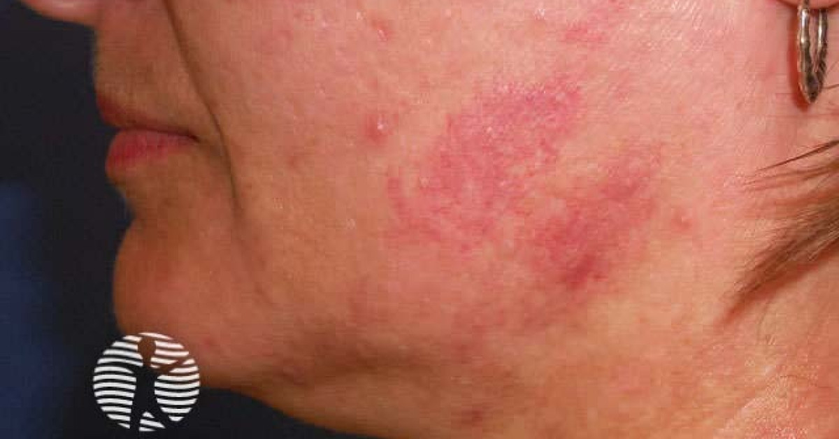 Acquired telangiectatic naevus image