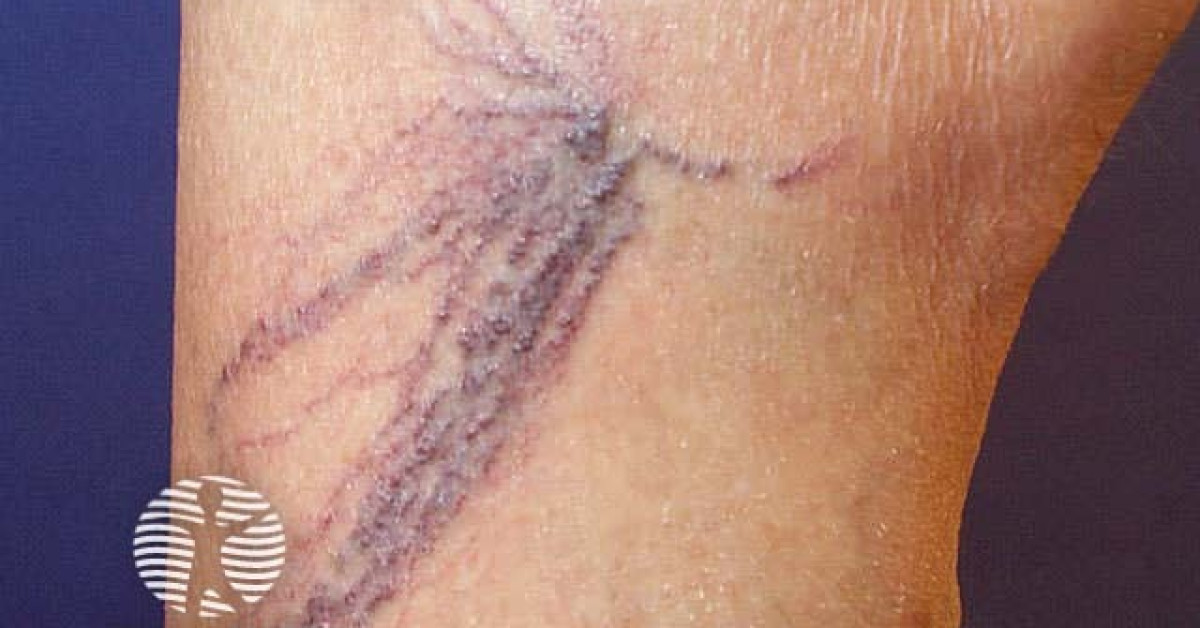 Thread veins / venulectasia image