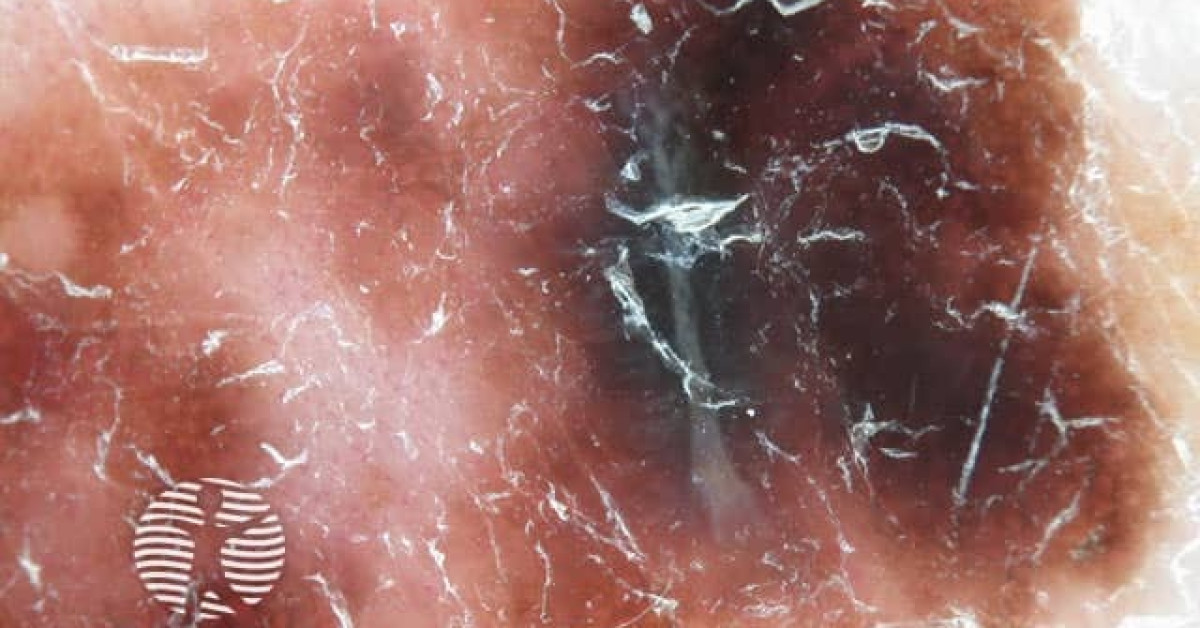 Melanoma image
