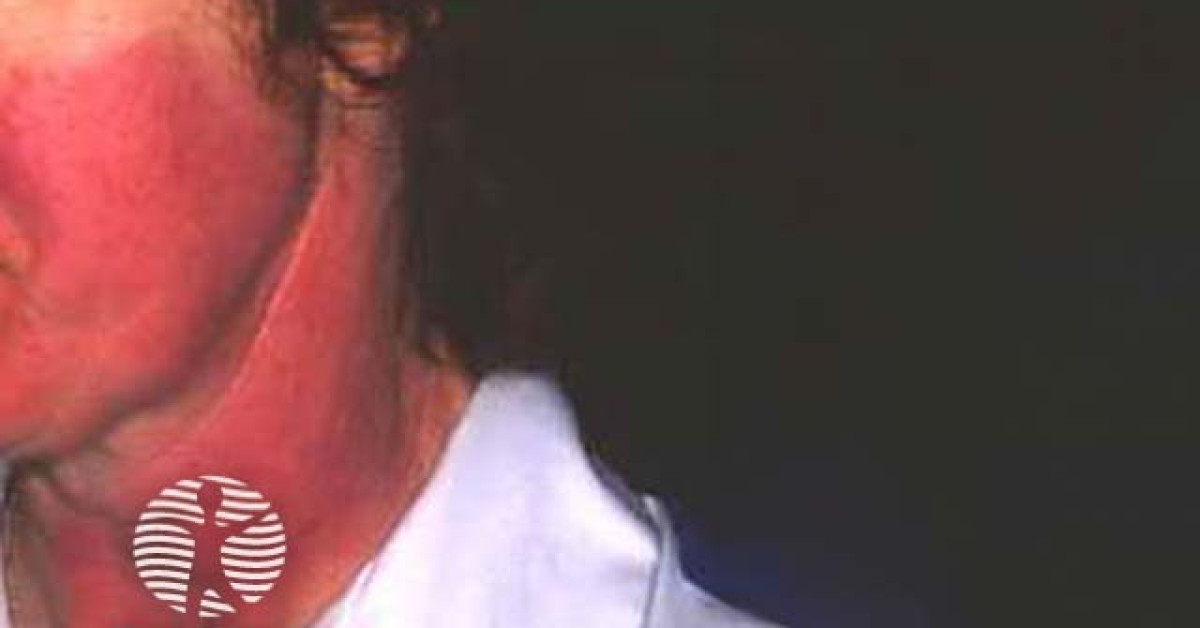 Phototherapy burn image