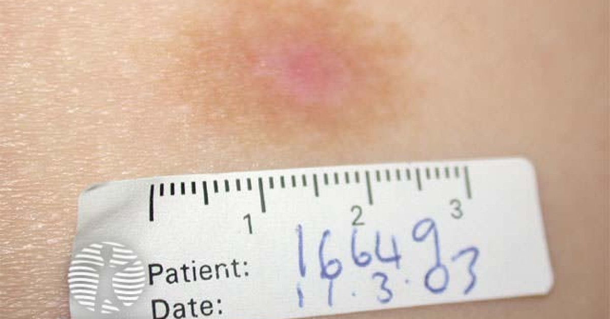 Pigmentary change from PDT image