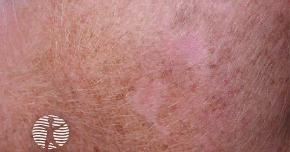 Pigmentary change from PDT image