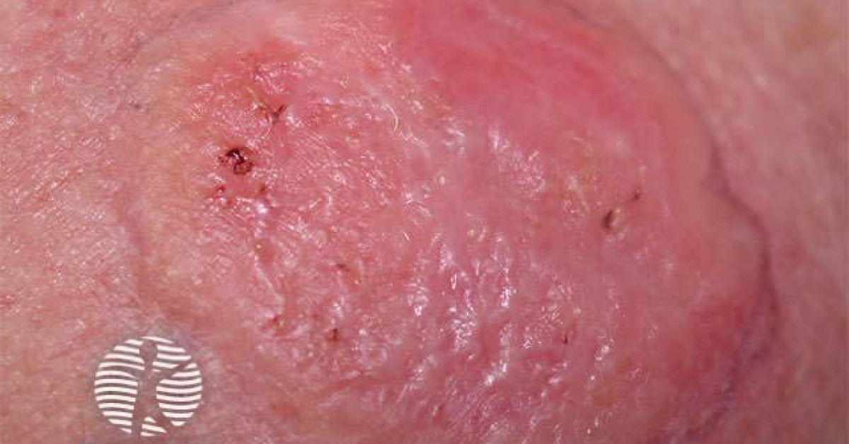 Urtication immediately after PDT image