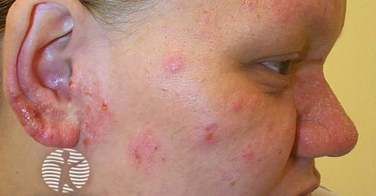 Photodermatitis: Polymorphic light eruption image