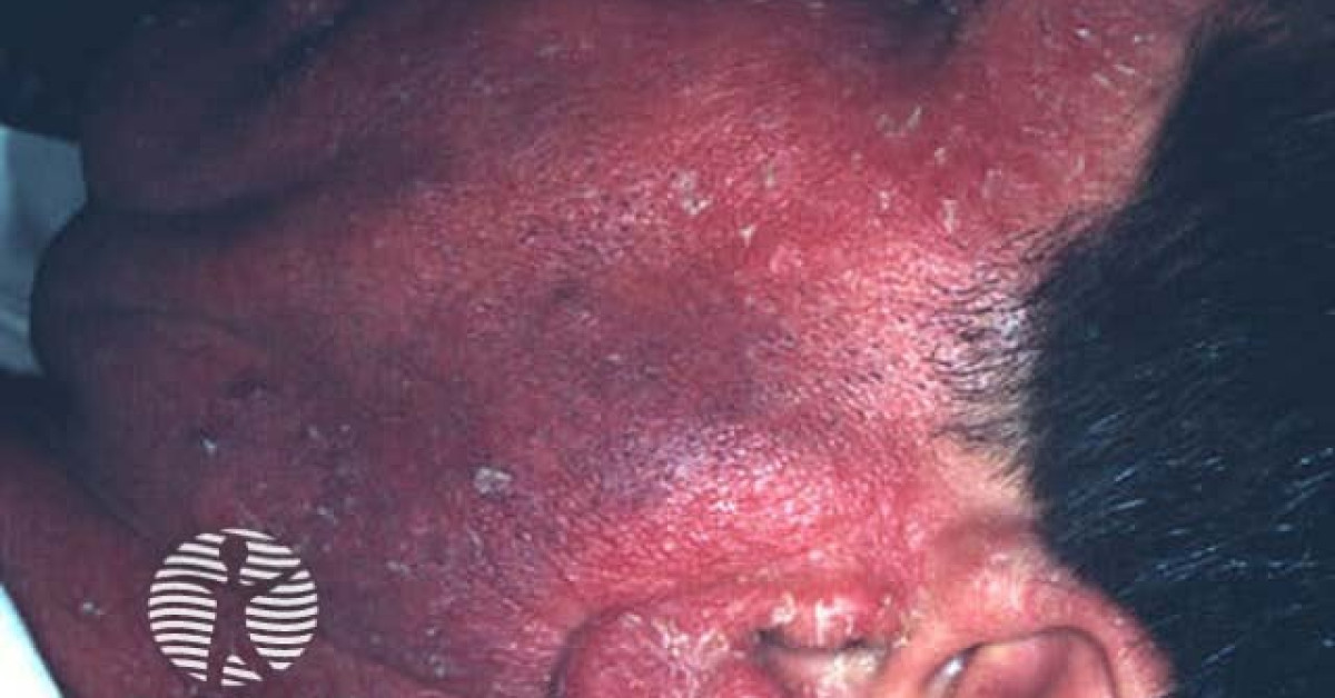 Eczematous eruption due to nonsteroidal anti-inflammatory drug image