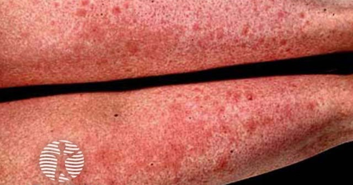 Polymorphic light eruption image