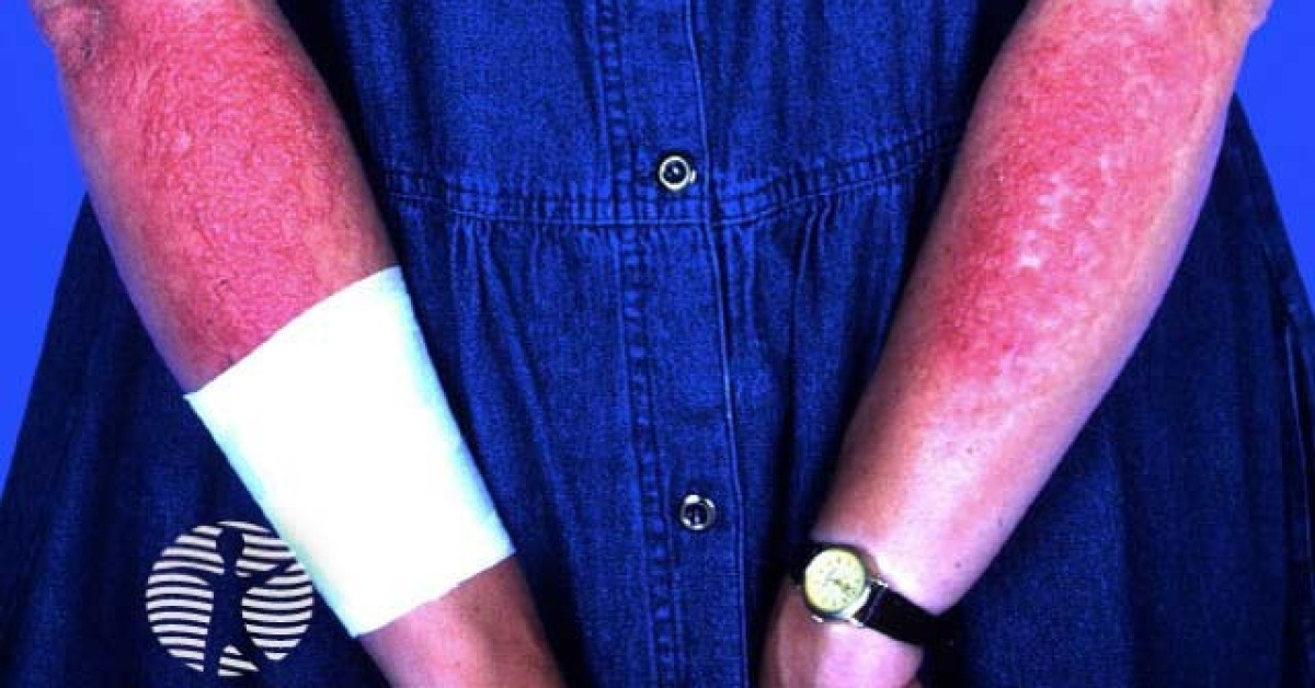 Photocontact reaction to sunscreen image