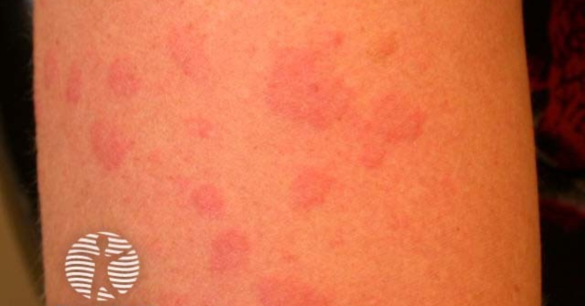 Solar urticaria image