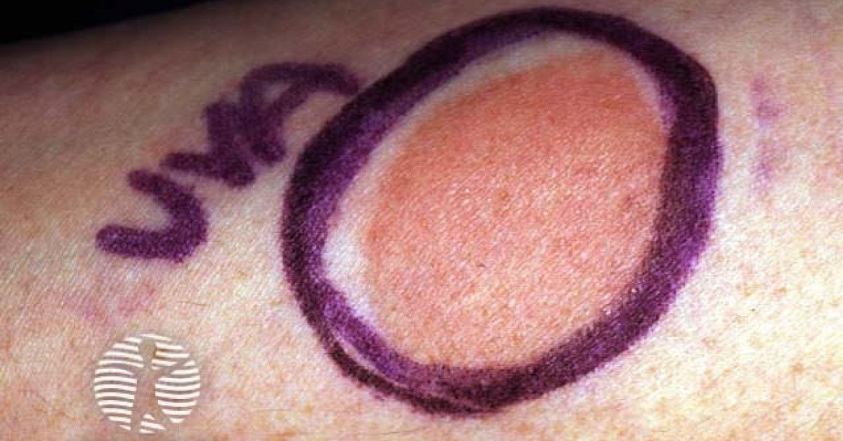 UVA-induced erythema image