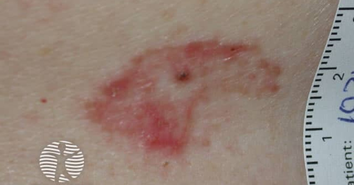Superficial basal cell carcinoma image