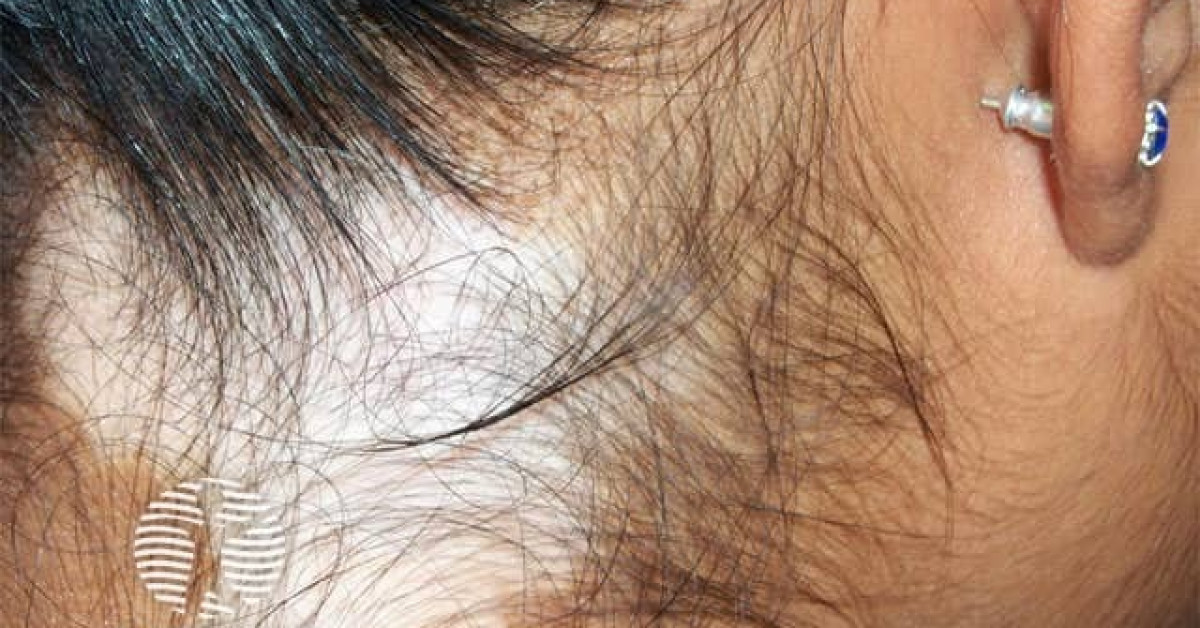 Vitiligo image