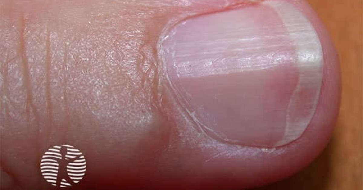 Nail groove image