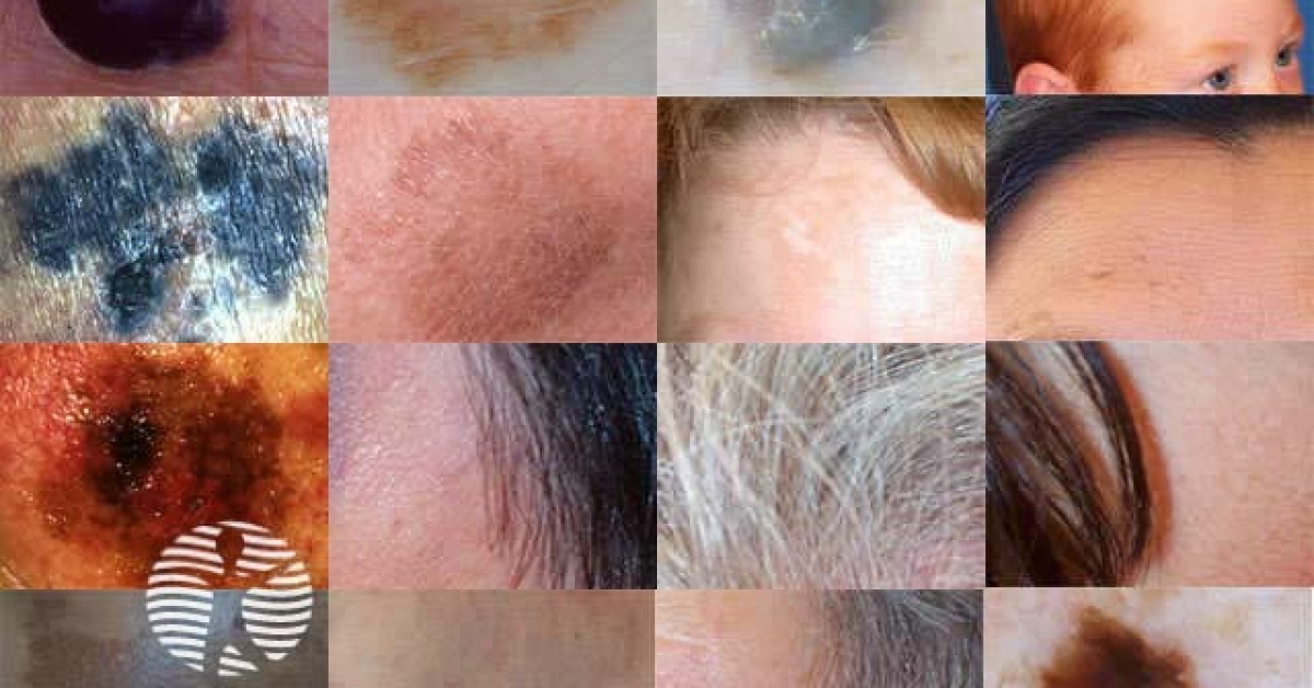 DermNet® - Variation in melanisation image