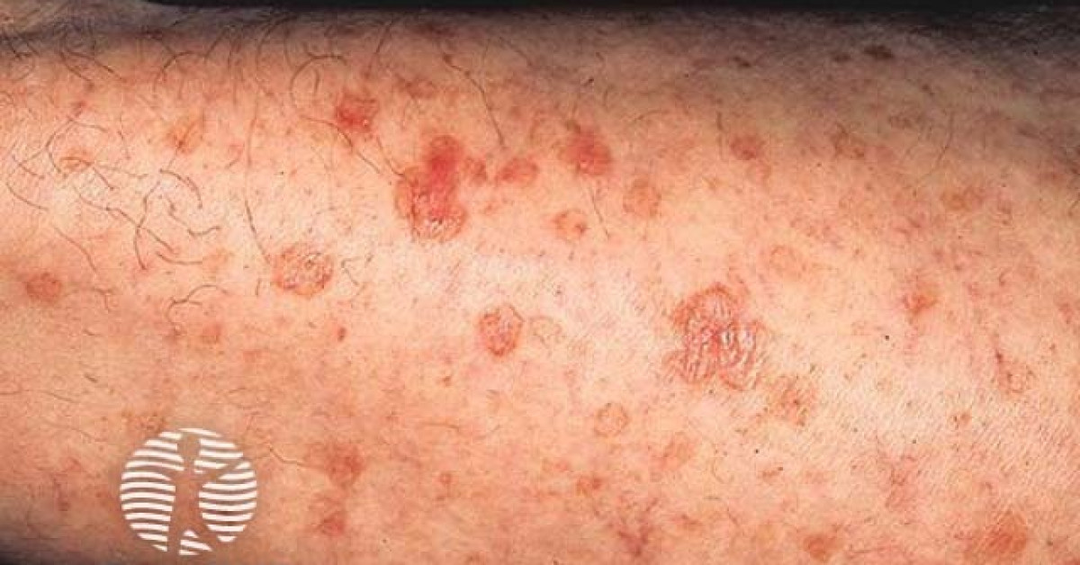 DermNet® - 015a image