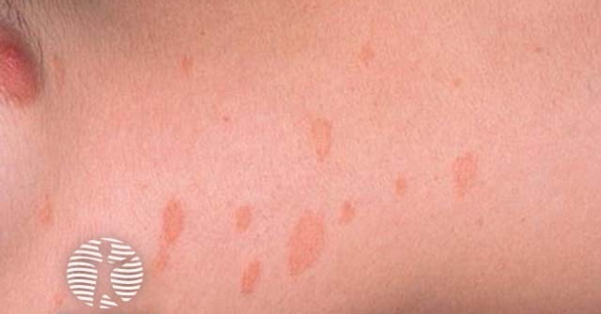 DermNet® - 029a image