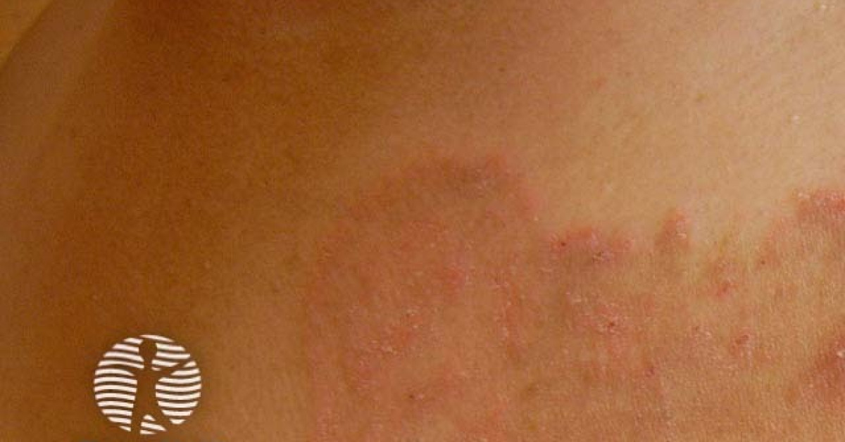 DermNet® - case12 image