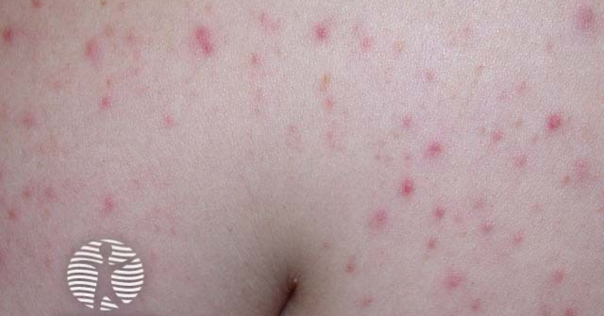 DermNet® - case8 image