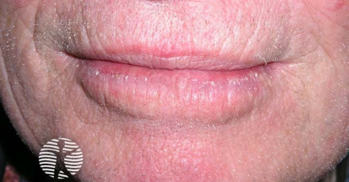 DermNet® - case14 image