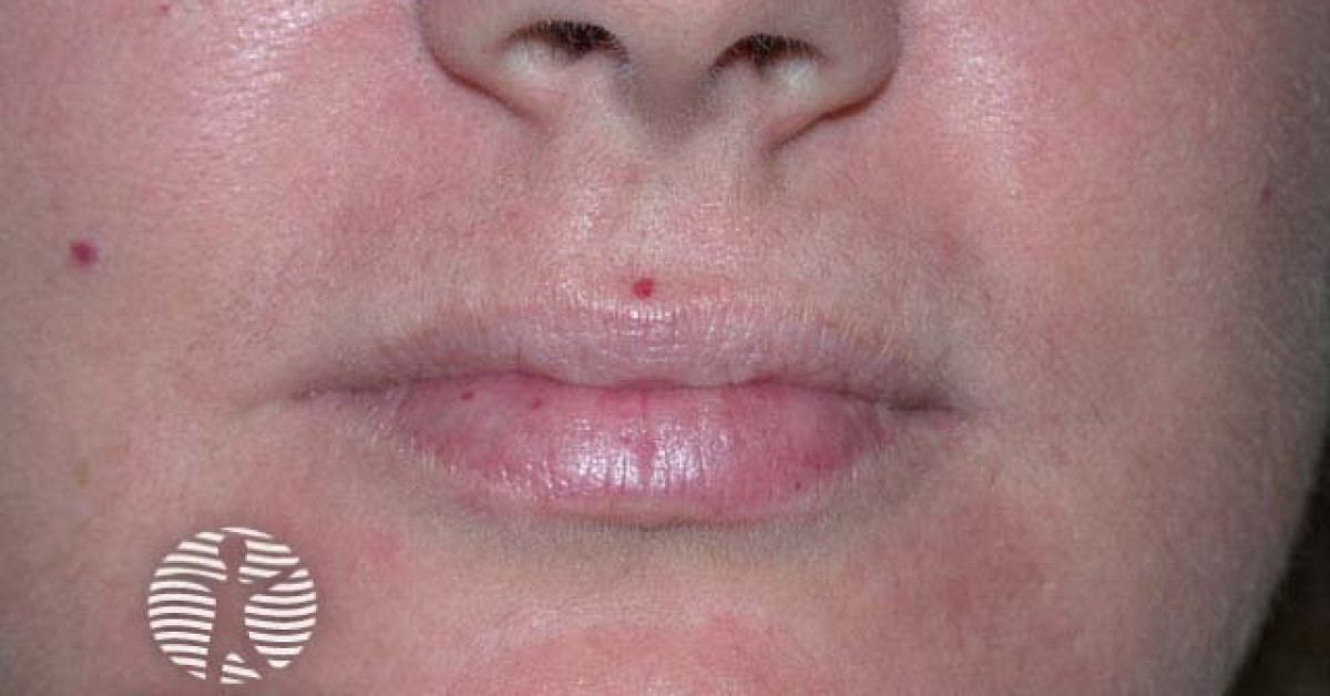 DermNet® - case5 image